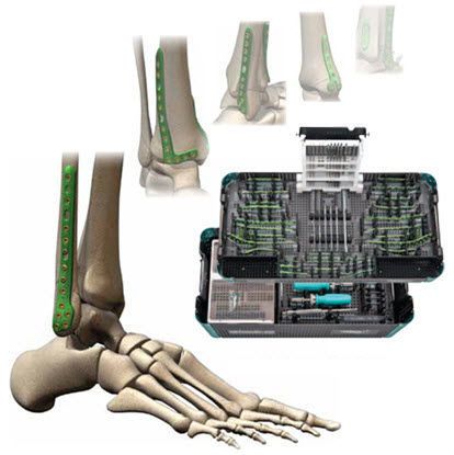 Health Management and Leadership Portal | Fibula compression bone plate ...