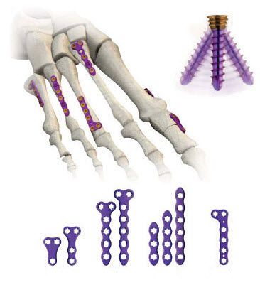 Health Management and Leadership Portal | Foot compression bone plate ...