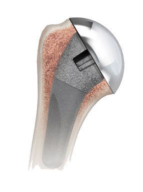 Health Management and Leadership Portal | Traditional total shoulder ...
