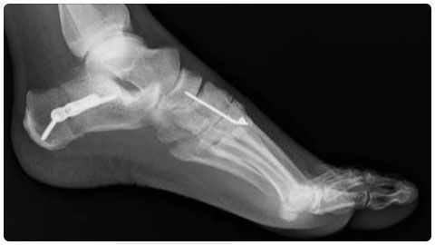 Health Management and Leadership Portal | Calcaneal displacement ...