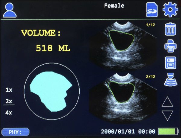 Health Management and Leadership Portal | Portable ultrasound bladder ...