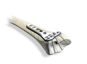 Health Management and Leadership Portal | Radius compression bone plate ...