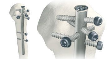 Health Management and Leadership Portal | Human intramedullary nail / humerus / proximal T2 ...