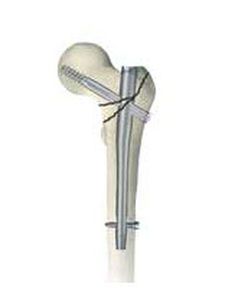 Health Management and Leadership Portal | Human intramedullary nail ...