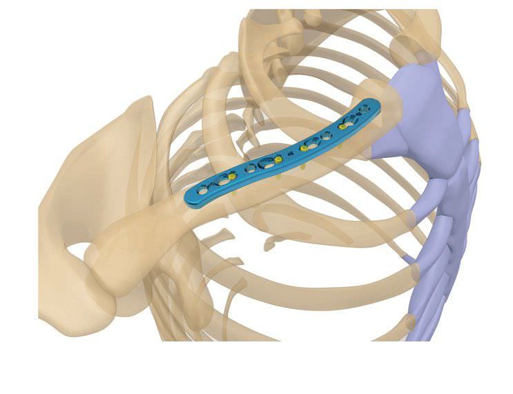 Health Management and Leadership Portal | Clavicle compression bone ...