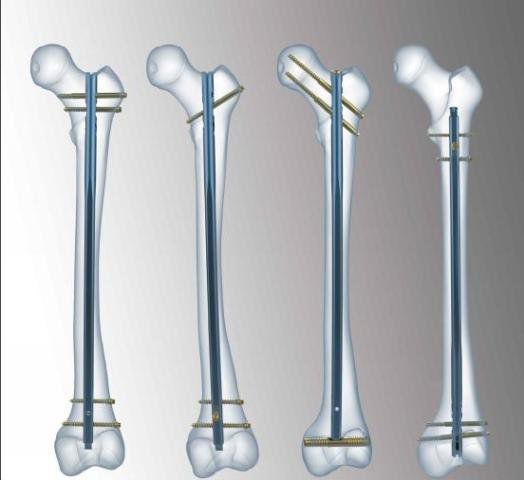 Health Management and Leadership Portal | Human intramedullary nail ...