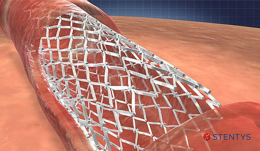 Health Management and Leadership Portal | Coronary stent / metal / bare ...