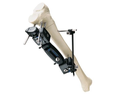 Health Management and Leadership Portal | Human external fixation ...