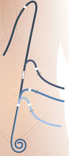 Health Management and Leadership Portal | Catheter guidewire InQwire ...