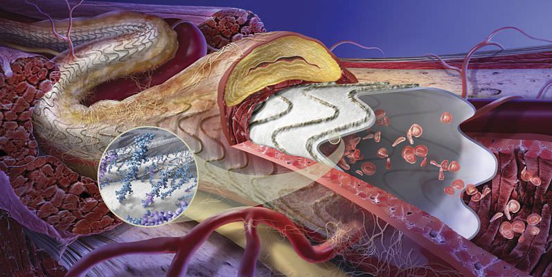 Health Management and Leadership Portal | Tunneling device vascular ...