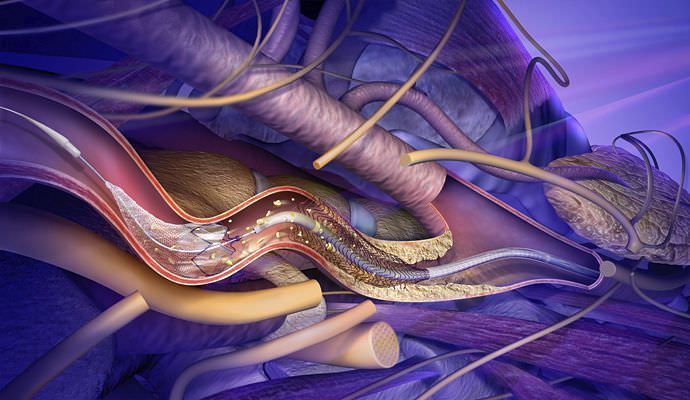 Health Management and Leadership Portal | Tunneling device vascular ...