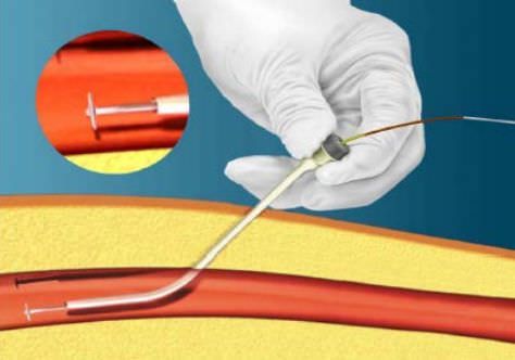 Health Management and Leadership Portal | Vascular closure system ...