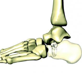 Health Management and Leadership Portal | Talo-calcaneal ligament ...