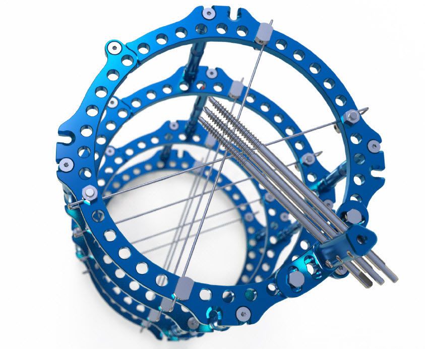 Health Management and Leadership Portal | Human external fixation ...