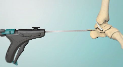 Health Management and Leadership Portal | Not absorbable suture anchor ...