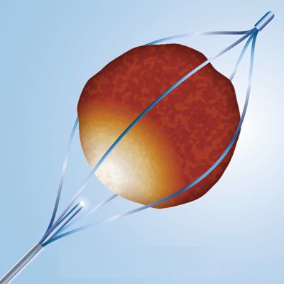 Health Management and Leadership Portal | Kidney stone extraction ...