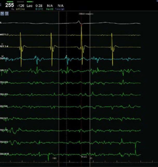 Health Management and Leadership Portal | Mapping catheter / diagnostic ...