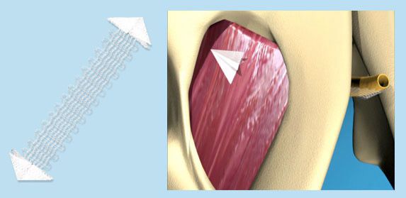 ASPIDE MEDICAL | HealthManagement.org