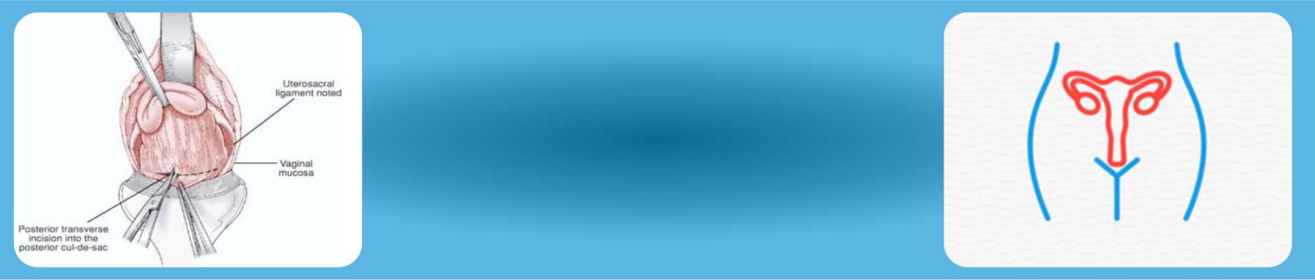 Viginal Hysterectomy Surgery in Varanasi | Heritage Hospital