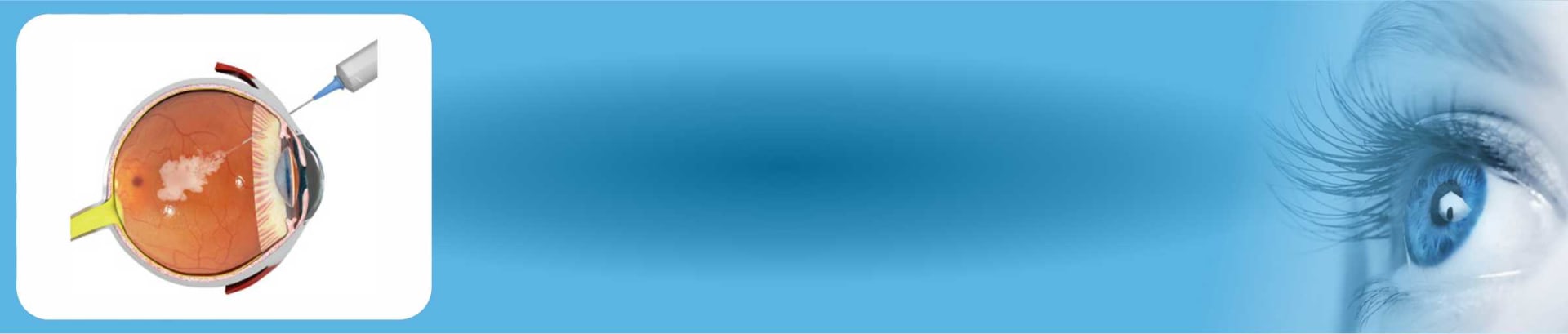 Best Intravitreal Injection Treatment in Varanasi | Heritage Hospital