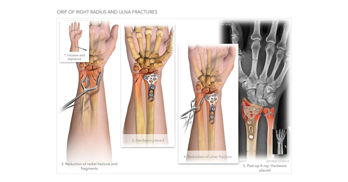 Wrist Fracture Open Reduction And Internal Or Externa