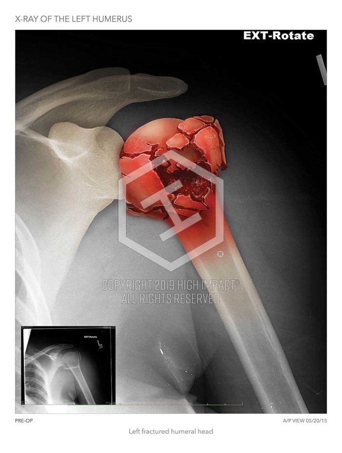 Humerus X Ray
