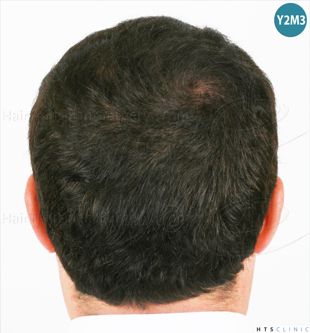 A very nice vertex work again | Hair loss Forum - Hair Transplant forums