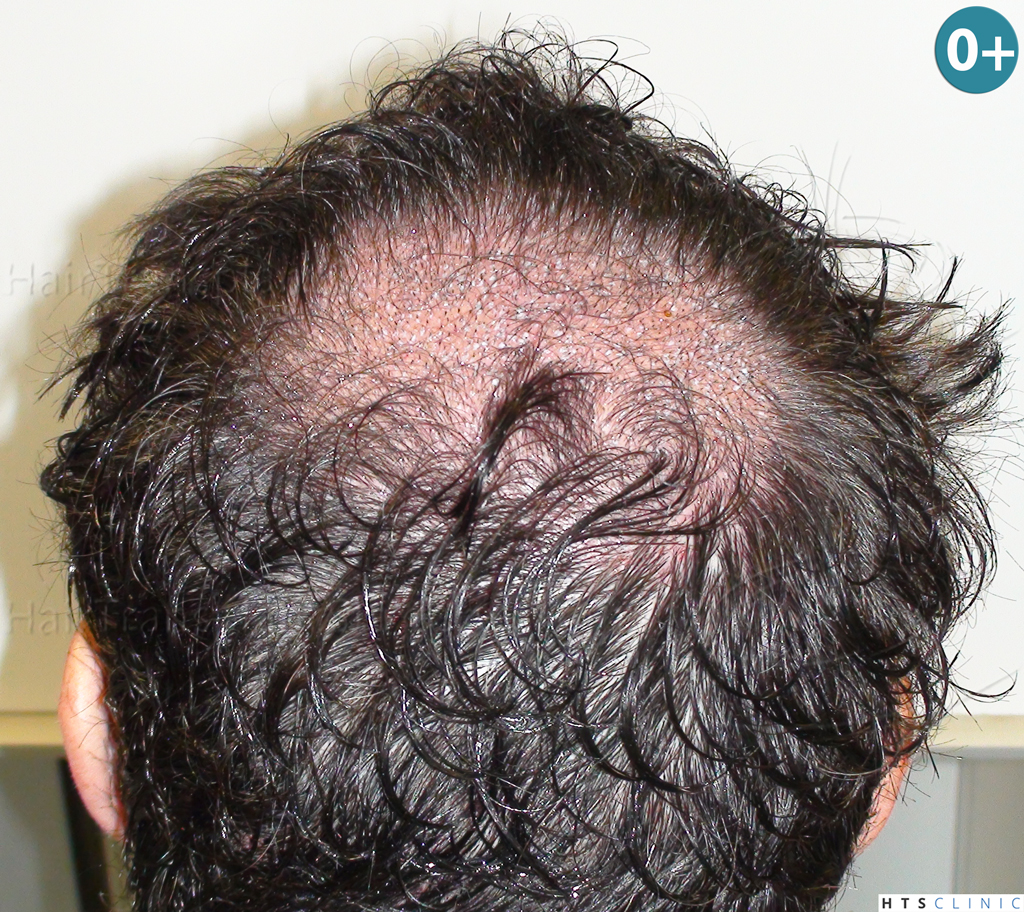 A very nice vertex work again | Hair loss Forum - Hair Transplant forums