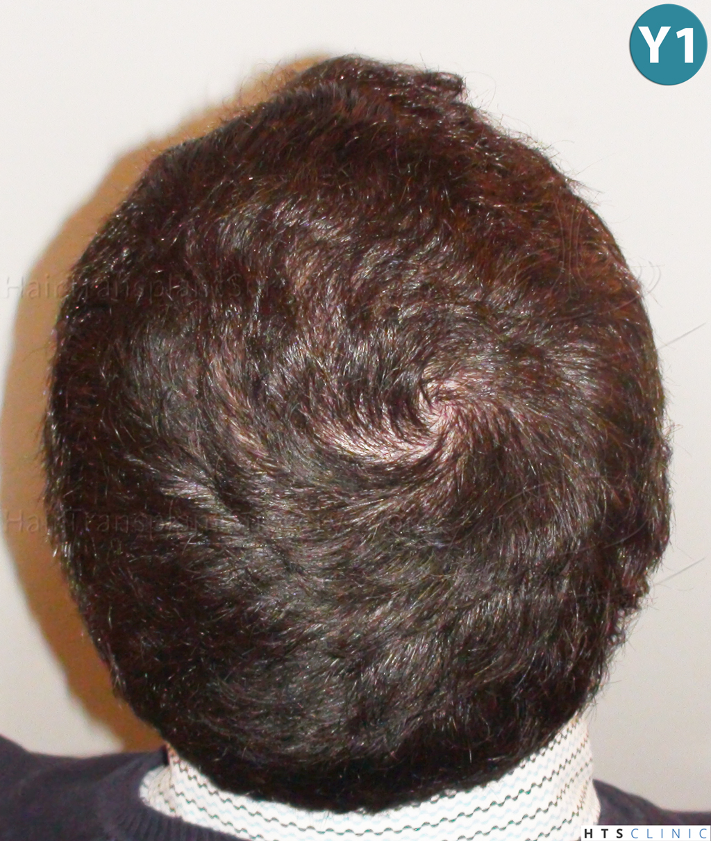 A very nice vertex work again | Hair loss Forum - Hair Transplant forums