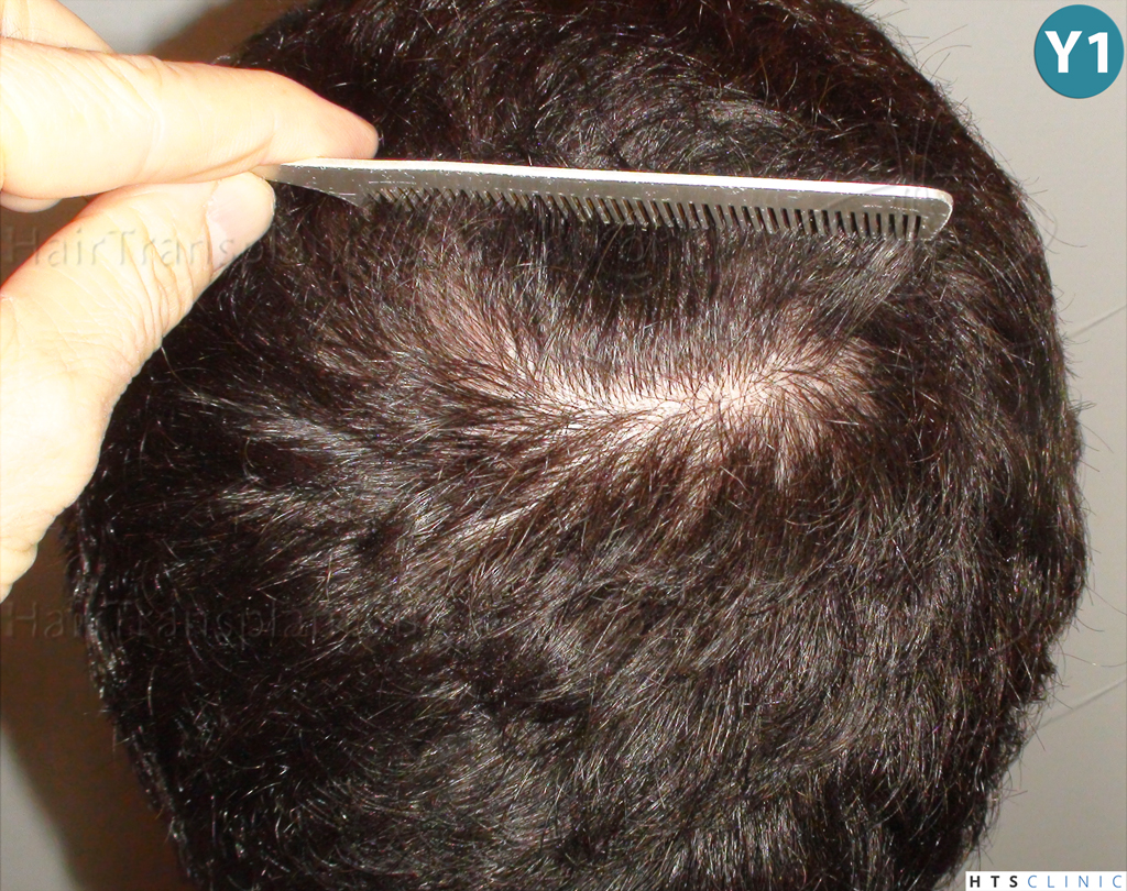 A very nice vertex work again | Hair loss Forum - Hair Transplant forums