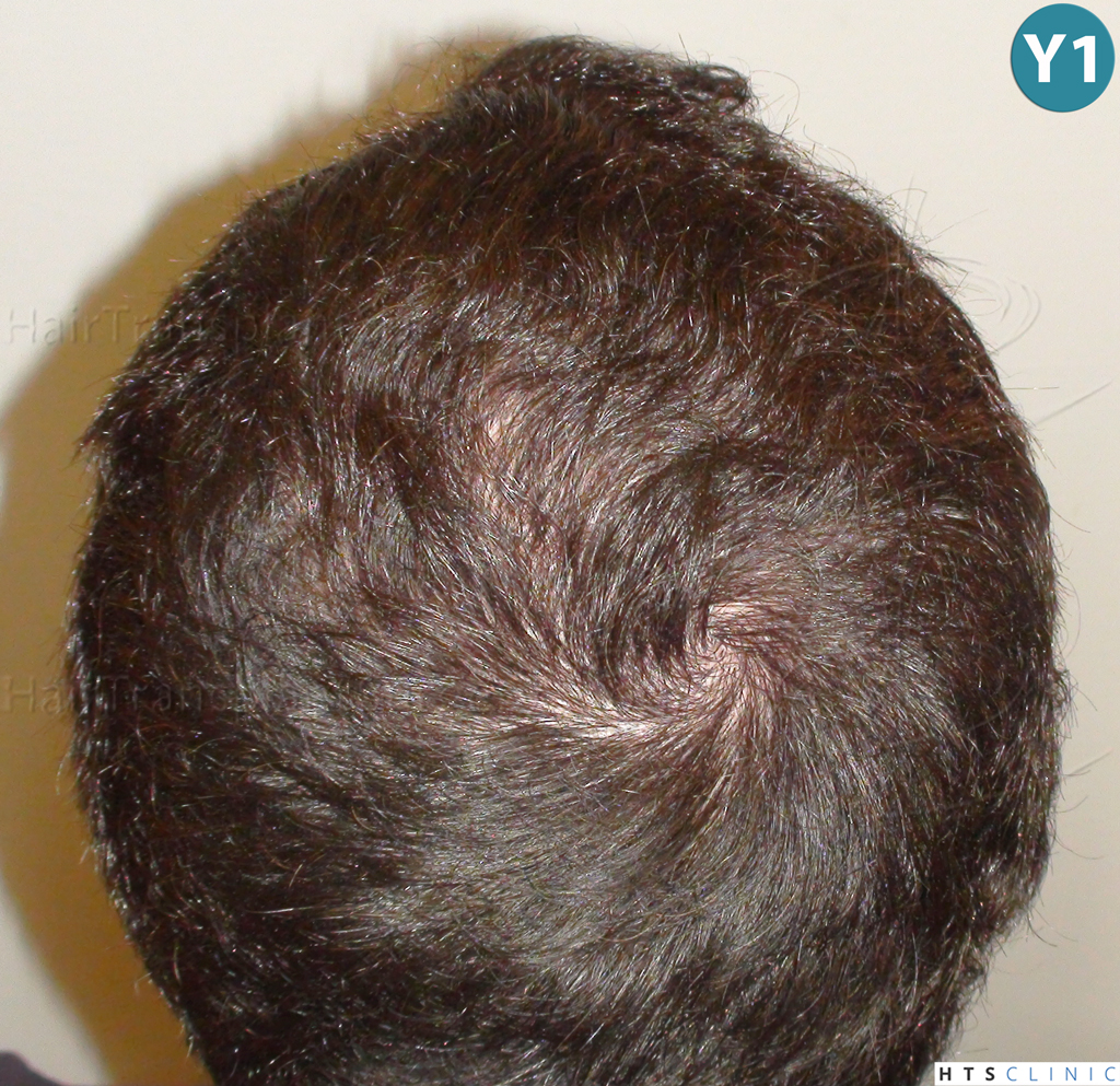 A very nice vertex work again | Hair loss Forum - Hair Transplant forums