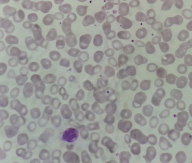 Polycythemia Vera - howitreat.in