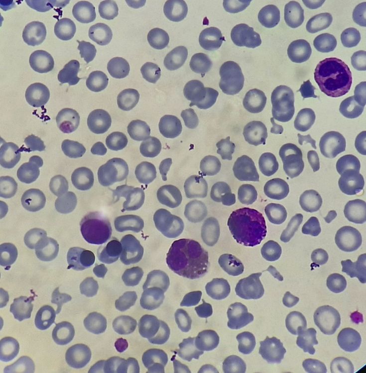 Primary Myelofibrosis - howitreat.in