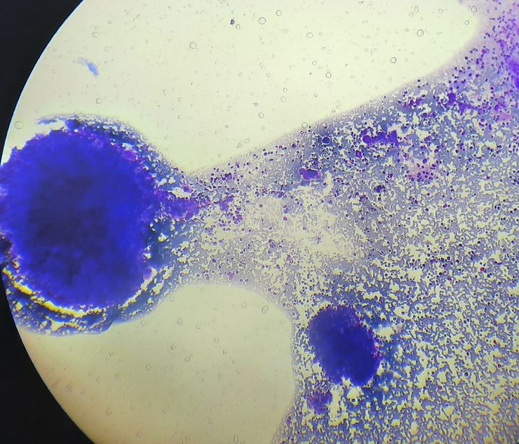 Polycythemia Vera - howitreat.in