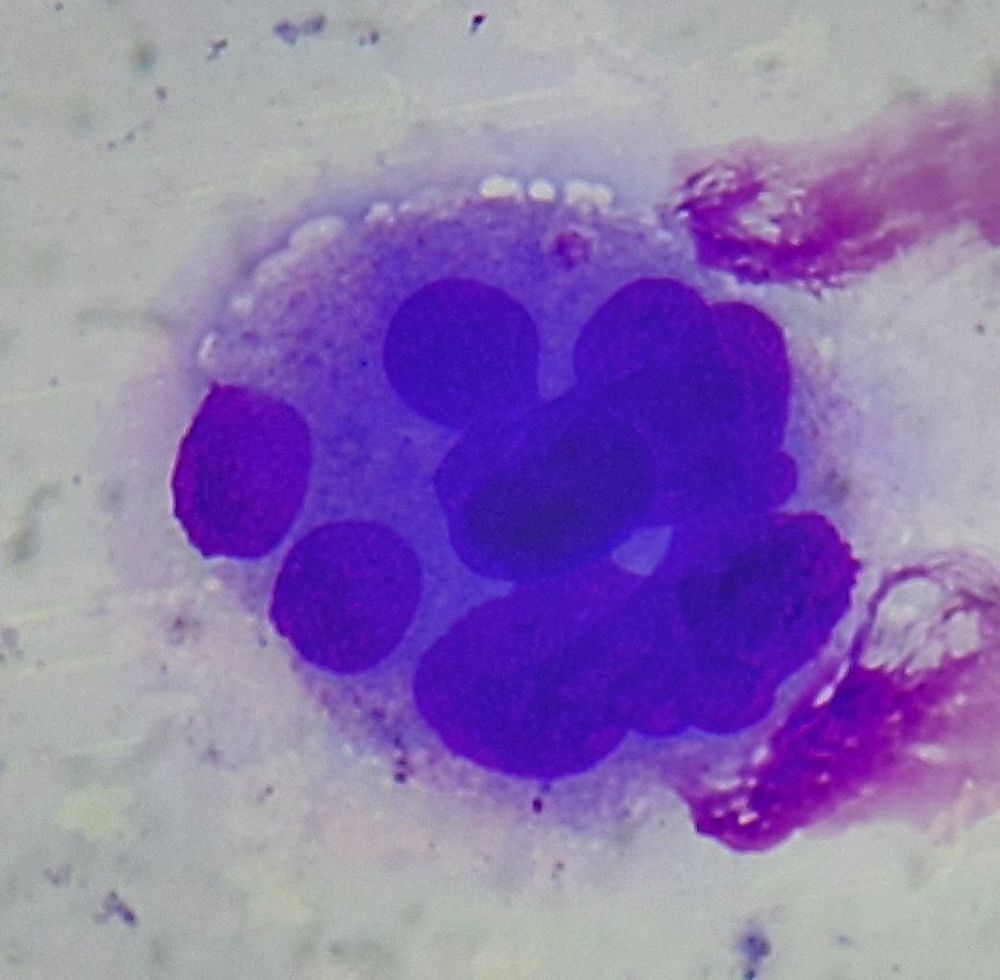Myelodysplastic Neoplasms (MDS) - howitreat.in