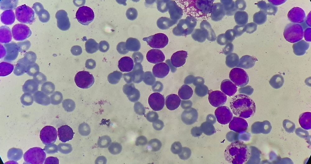Acute Lymphoblastic Leukemia/ Lymphoma - howitreat.in