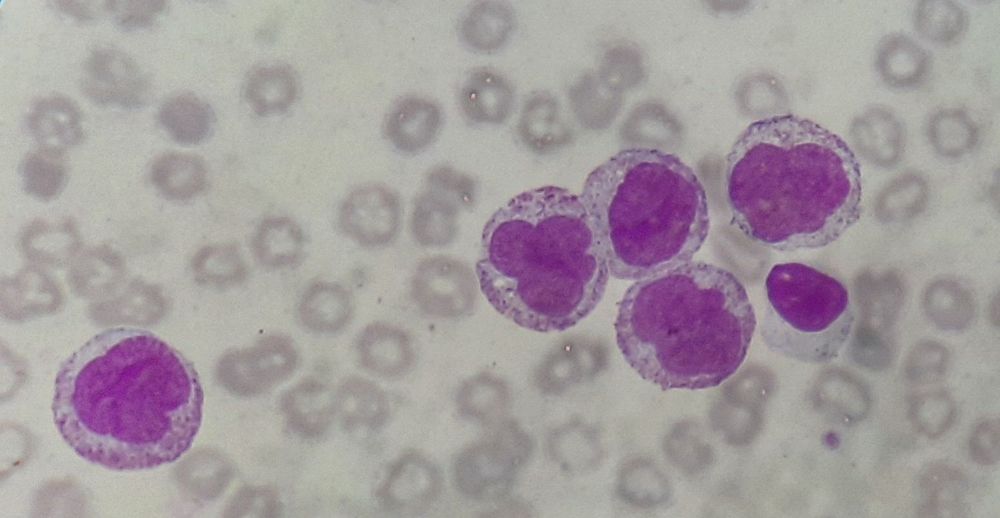 Acute Myeloid Leukemia - howitreat.in