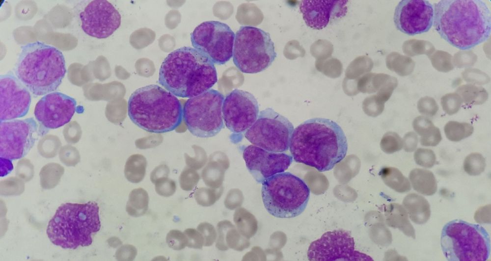 Acute Myeloid Leukemia - howitreat.in