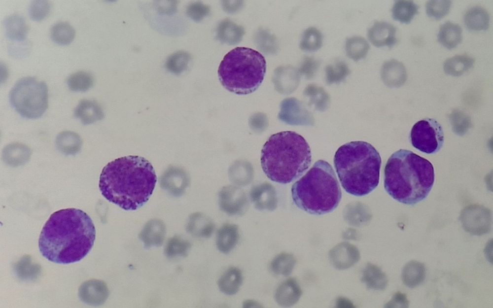 Acute Promyelocytic Leukemia - howitreat.in