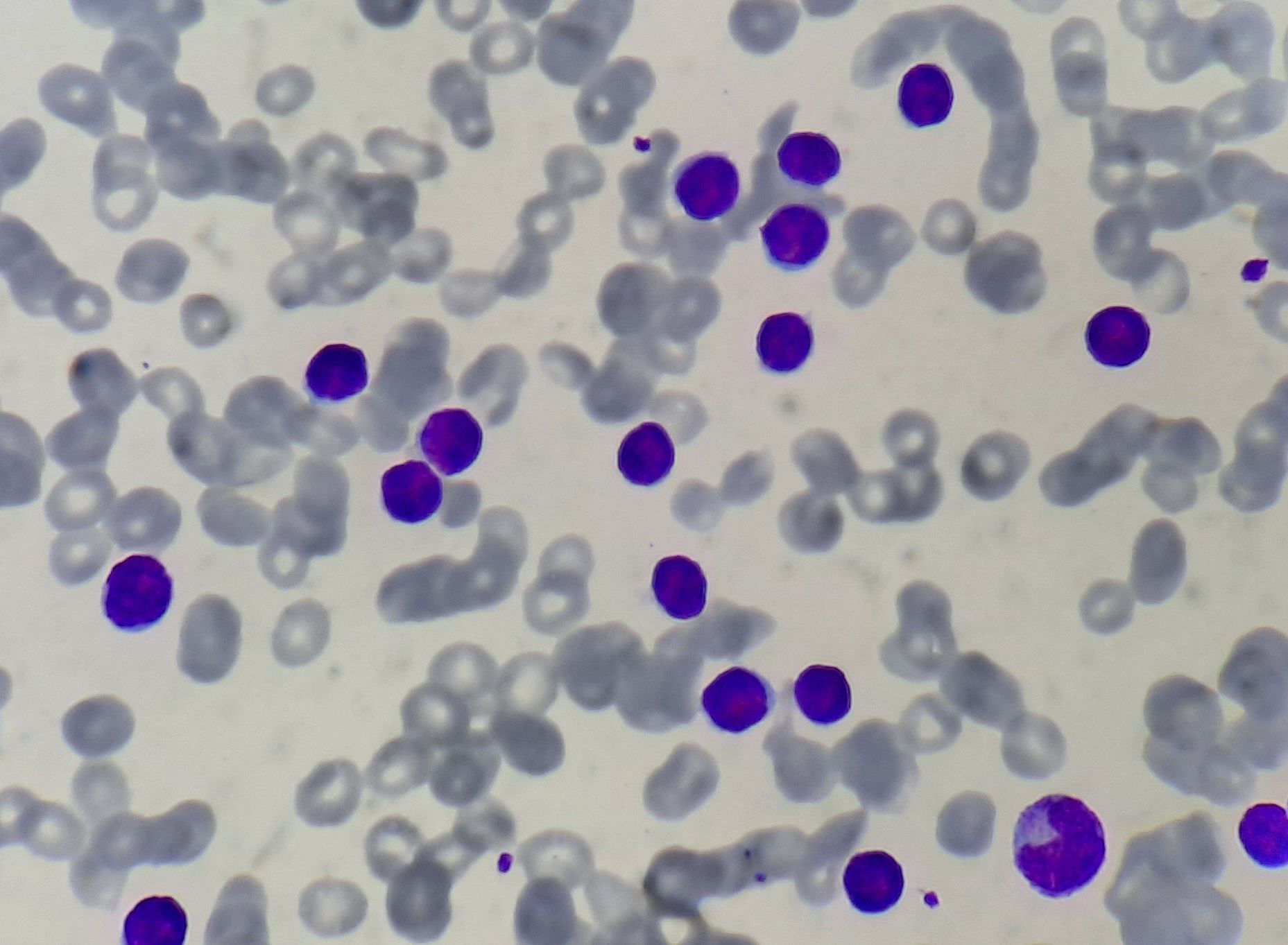Chronic Lymphocytic Leukemia Small Lymphocytic Lymphoma