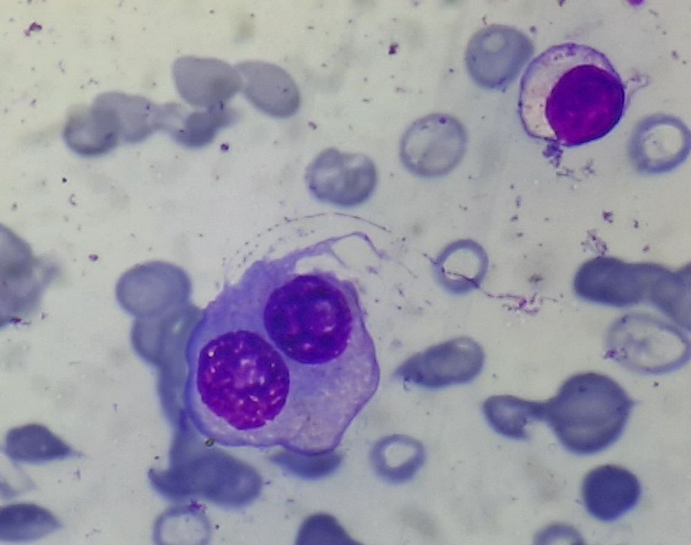 Plasma Cell Neoplasms - howitreat.in