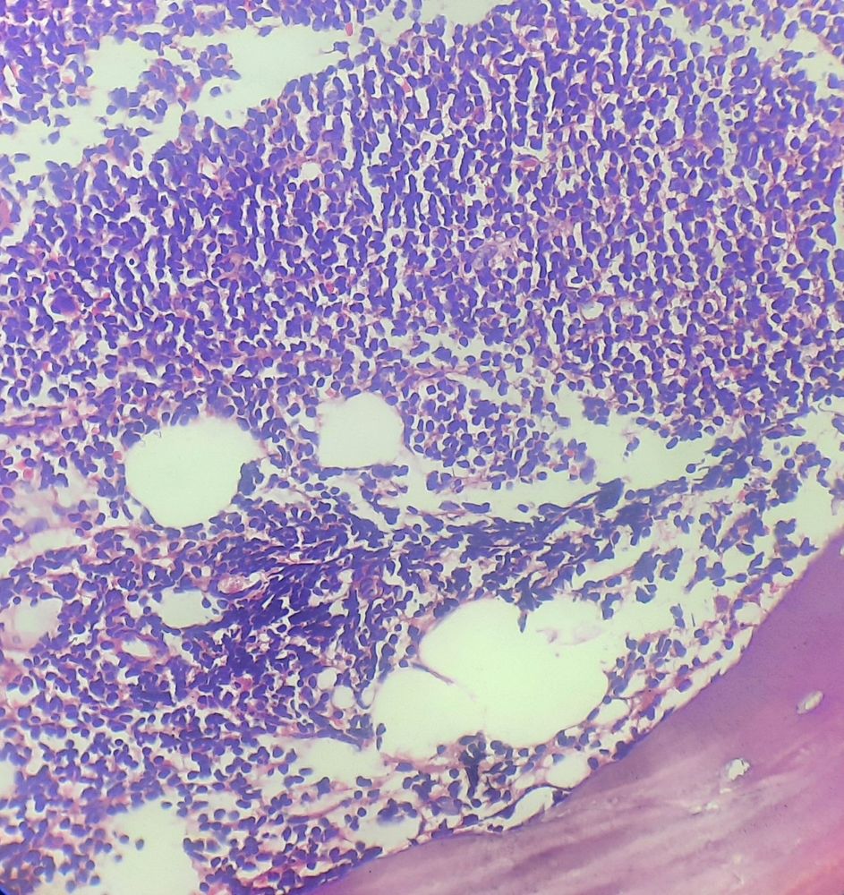 Chronic Lymphocytic Leukemia/ Small Lymphocytic Lymphoma - howitreat.in