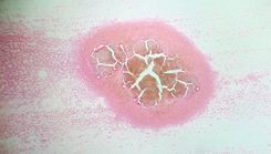 Iron Deficiency Anemia - howitreat.in