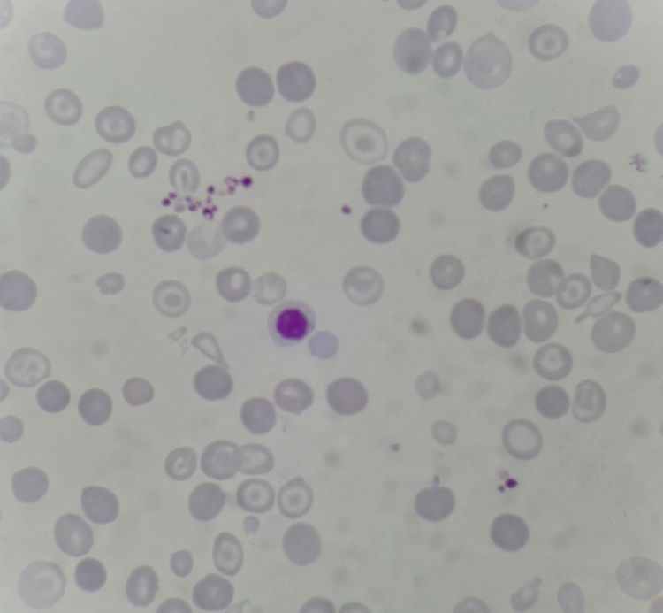 Alpha Thalassemia - howitreat.in