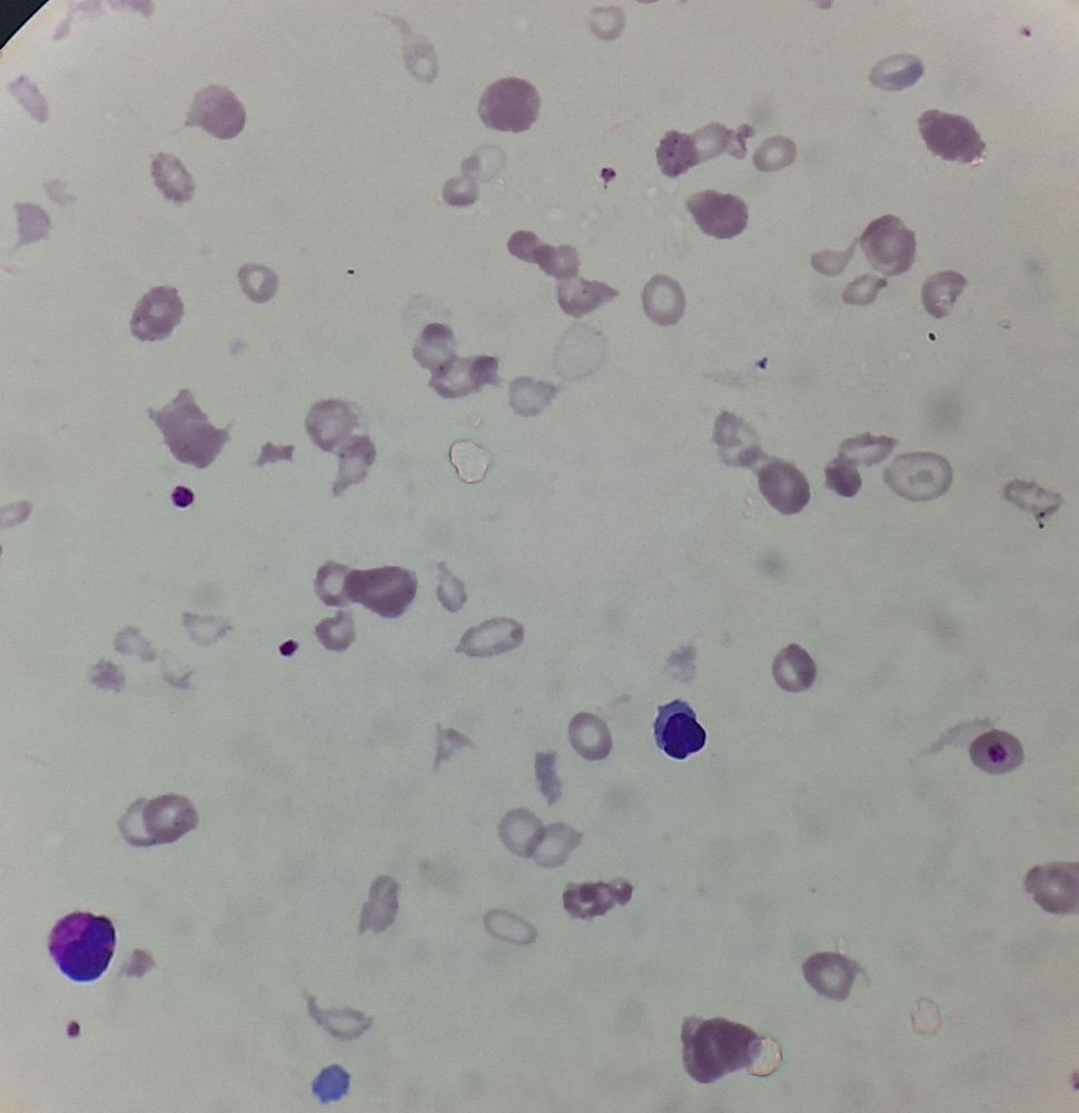 Beta Thalassemia - howitreat.in
