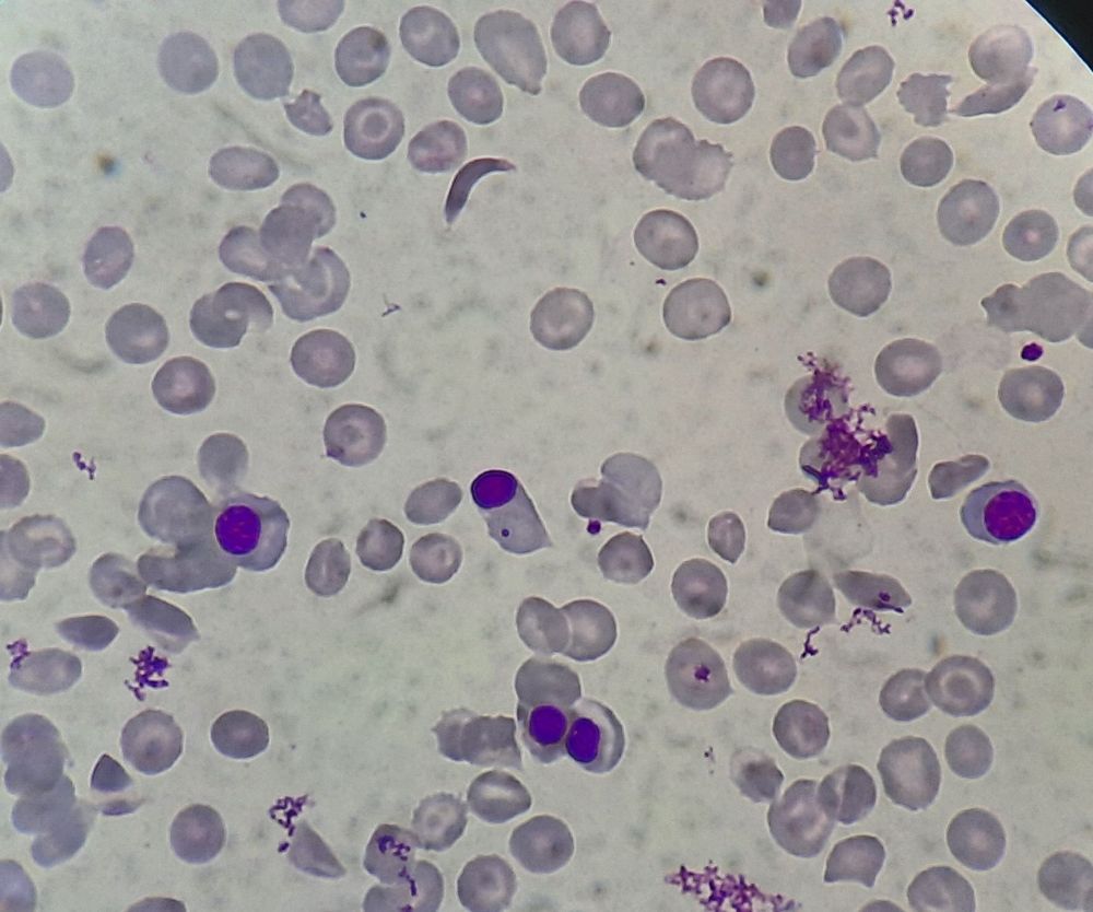 Sickle Cell Anemia - howitreat.in