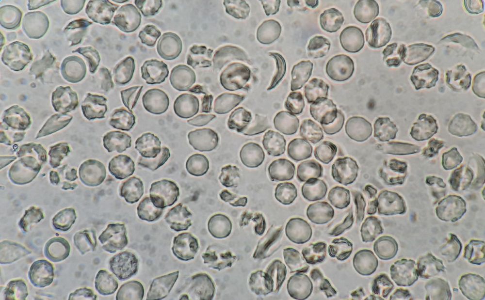 Sickle Cell Anemia - howitreat.in