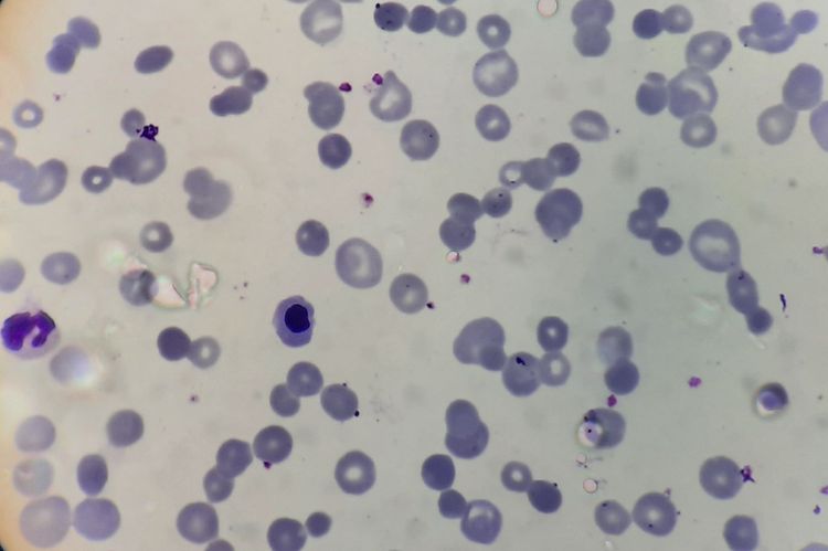 Auto-immune Hemolytic Anemia - howitreat.in