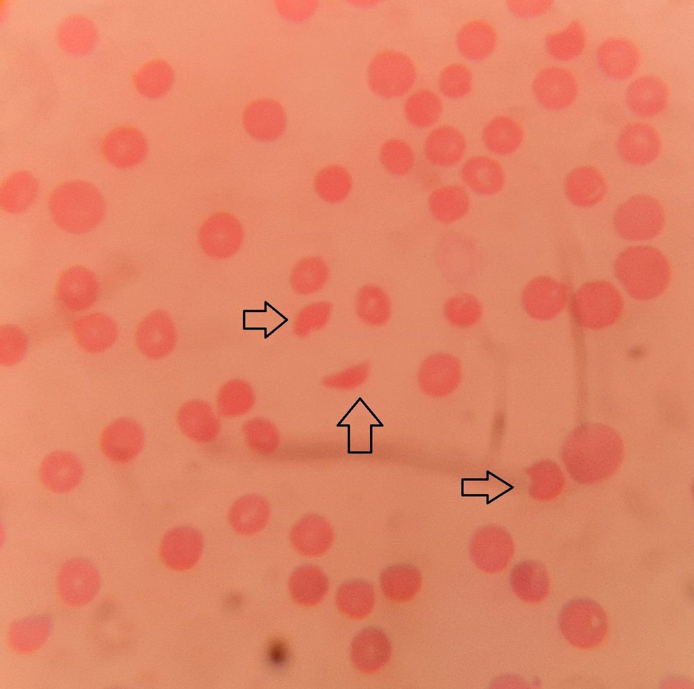 Thrombotic Thrombocytopenic Purpura - howitreat.in