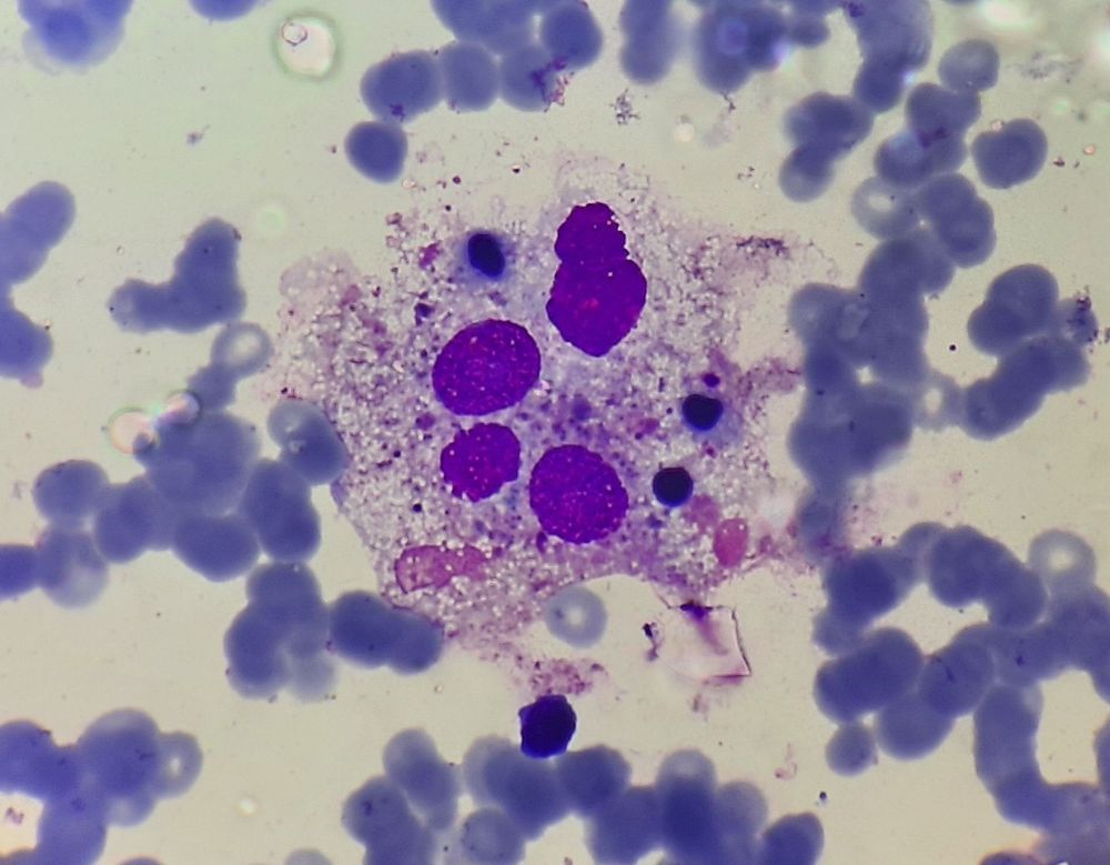 Hemophagocytic Lymphohistiocytosis - howitreat.in